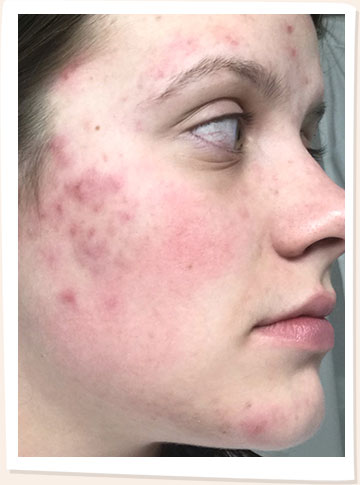 Spotless Regimen for Teen Acne | Rodan + Fields®