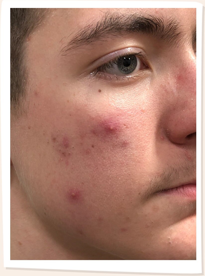 Spotless Regimen for Teen Acne | Rodan + Fields®