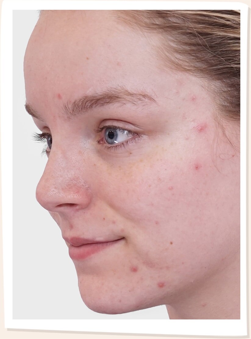 Spotless Regimen for Teen Acne | Rodan + Fields®