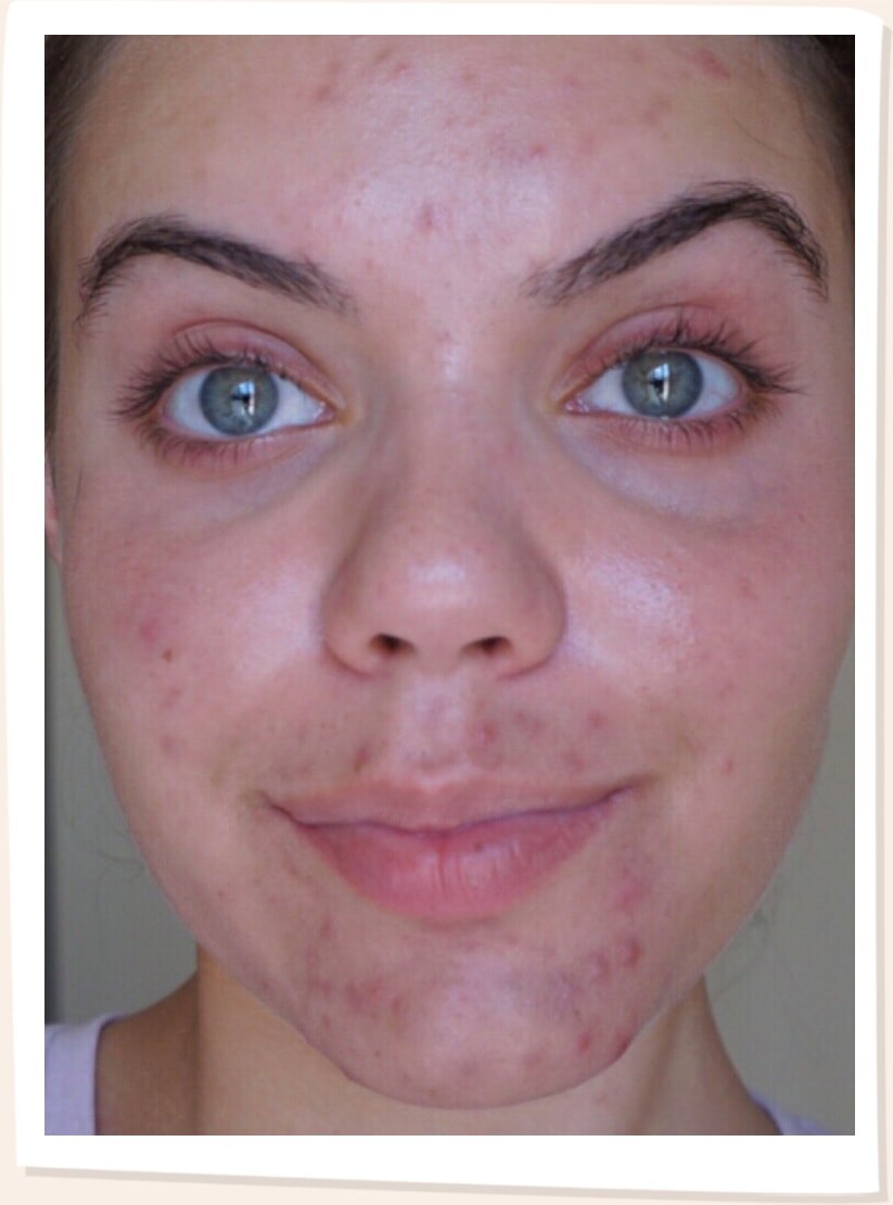 Spotless Regimen for Teen Acne | Rodan + Fields®